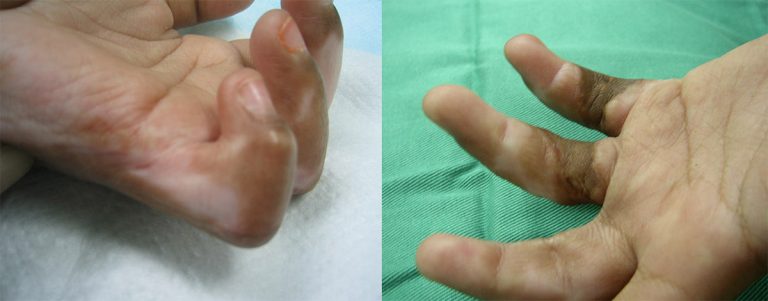 Burn Injuries – MSPRS